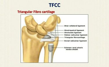 TFCC: Triangular Fibrocartilage Complex Injuries - MHT